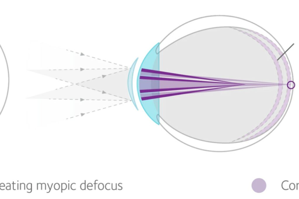 What Are the Benefits of Myopia Control?